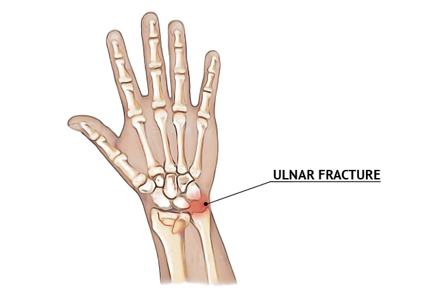Ulnar Styloid Fracture